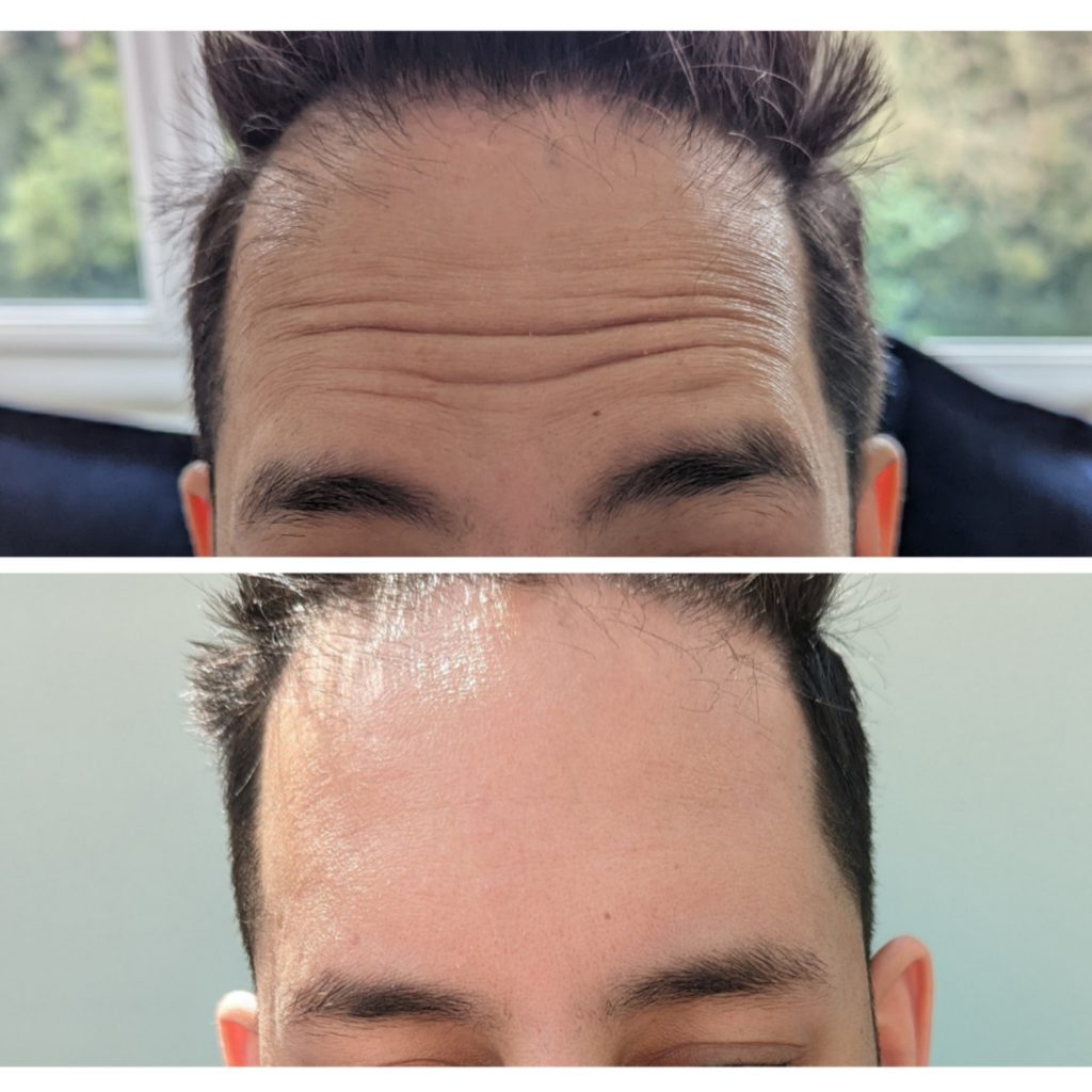 am-i-too-old-for-botox-unndoo-blog